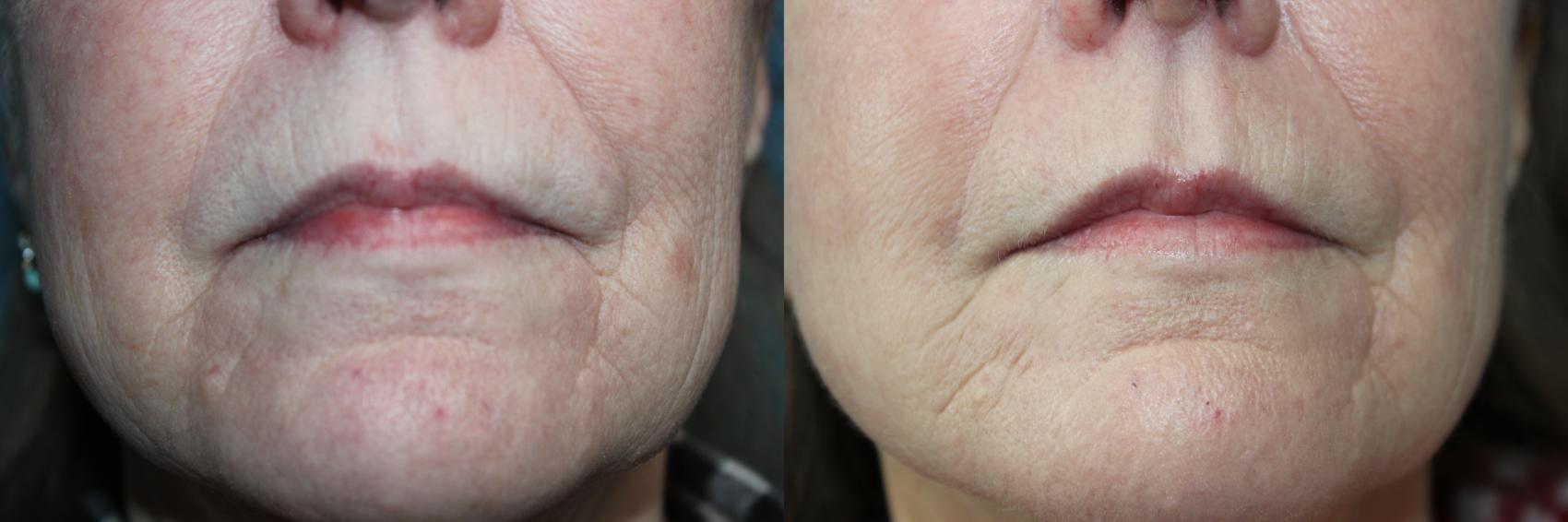 Laser Skin Rejuvenation Before & After Pictures Case 211 – Coeur d ...