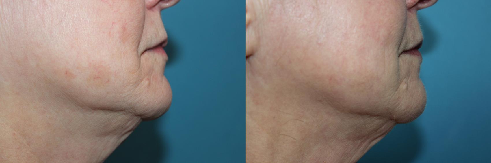 Laser Skin Rejuvenation Before & After Pictures Case 211 – Coeur d ...