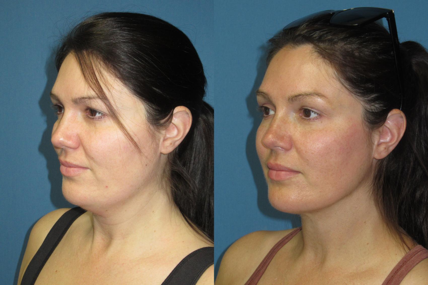 Liposuction - Neck / Precision TX Face & Neck Before & After Pictures ...